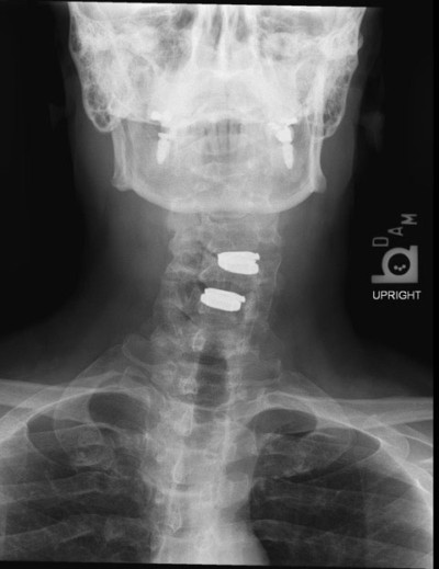 Failure of Cervical Artificial Discs | Spine Specialist