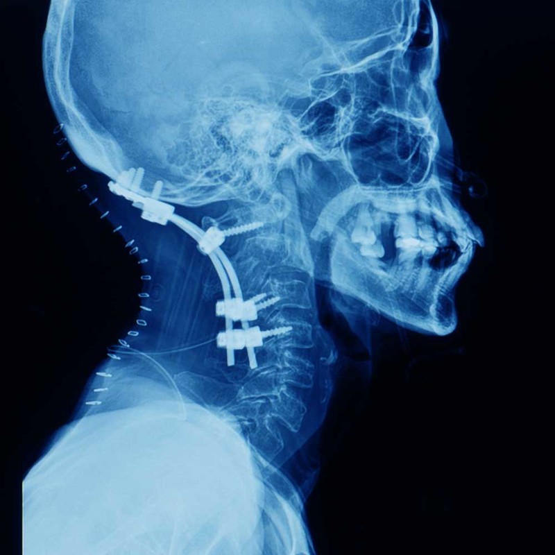 Recovery Information Archives » Donald Corenman MD DC | Spine Surgeon ...