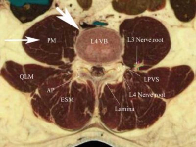 Far Lateral Lumbar Spine Fusions | Oblique Lateral Interbody Fusion ...