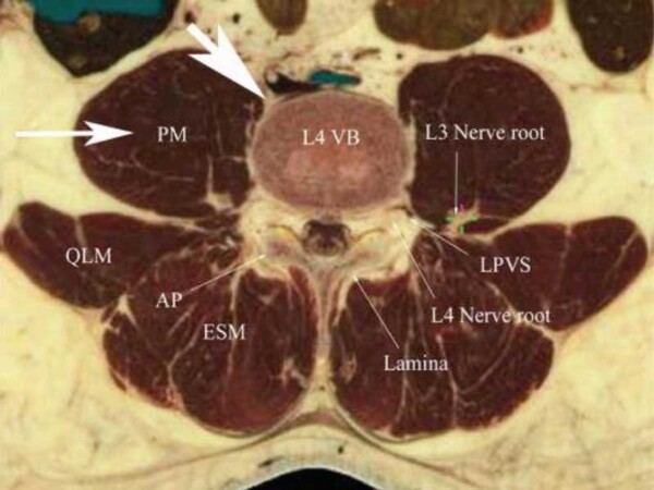 Far Lateral Lumbar Spine Fusions | Oblique Lateral Interbody Fusion ...