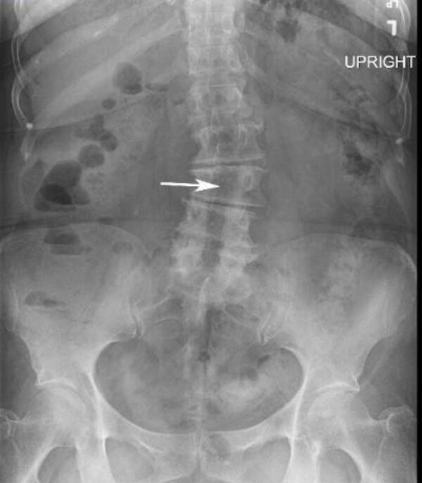 Far Lateral Lumbar Spine Fusions | Oblique Lateral Interbody Fusion ...