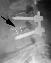 Far Lateral Lumbar Spine Fusions | Direct Lateral Interbody Fusion ...