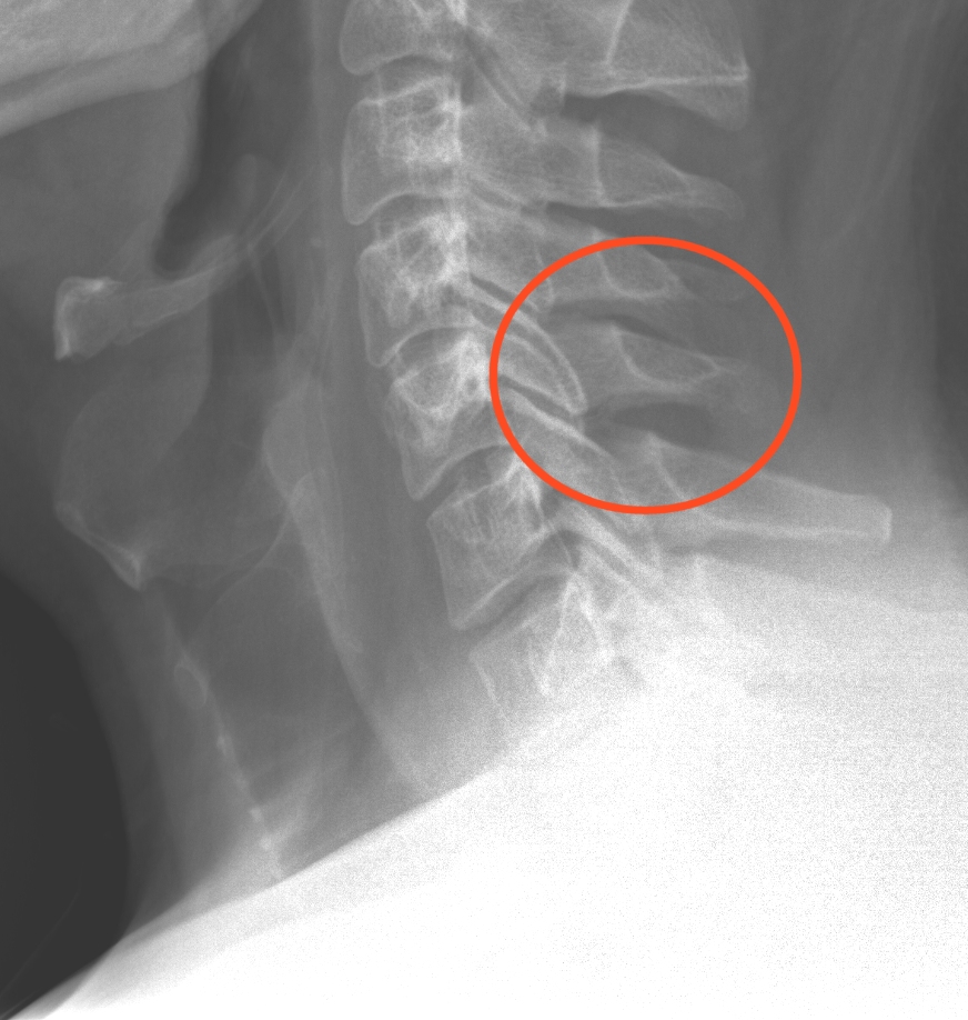 Dark Shadow on Lateral Cervical X-Ray?