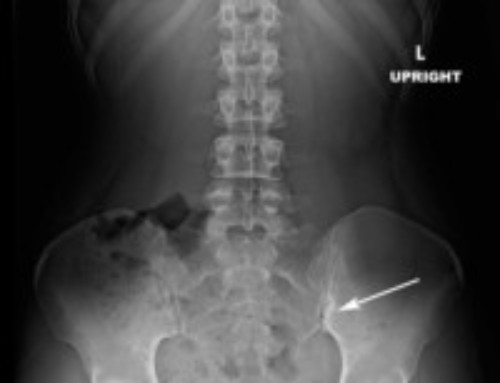 Epidural Steroid Injections | Selective Nerve Root Blocks