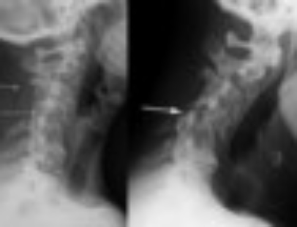 Cervical Degenerative Disc Disease | Spine Specialist | Vail, Aspen ...